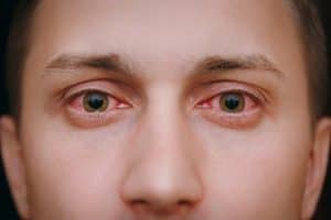 Why Does Weed Make Your Eyes Red: The Different Reasons | Cannabis Sensei